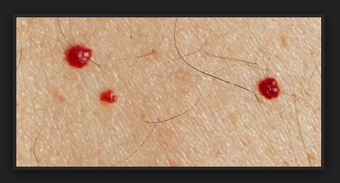 Você tem manchas vermelhas em qualquer parte do corpo? Você deve se ...