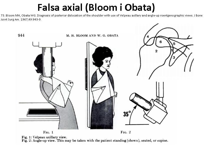 CORACOIDES: RX axial