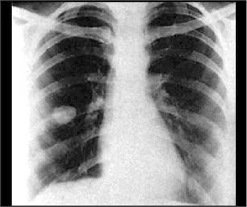 Dentistry and Medicine: Acid fast Bacilli