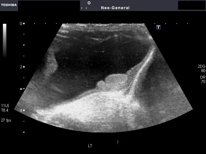 ON - RADIOLOGY: Ultrasound showing Bilateral communicating hydrocele in ...