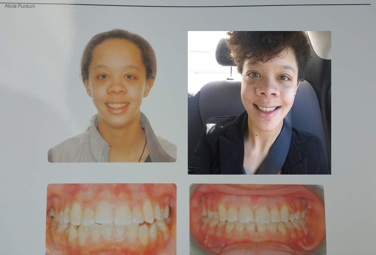 The Girl With the Screwed Up Jaw