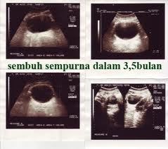 XAMthone Riau: Kista Ovarium