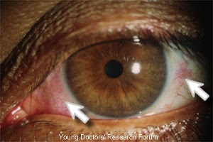 Images For Conjunctival Xerosis (Dry Eye) And Bitot's Spot ~ YOUNG ...