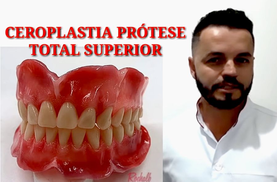 PRÓTESE DENTAL: Ceroplastia de uma prótese total superior - passo a passo