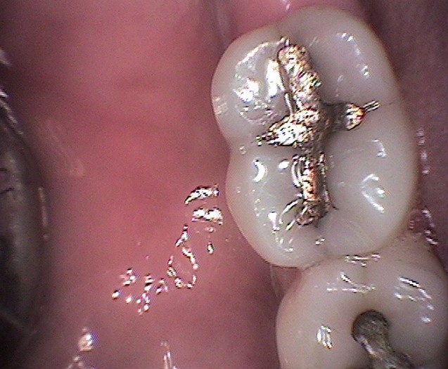 THE SECRET ABOUT SILVER FILLINGS: Silver Fillings
