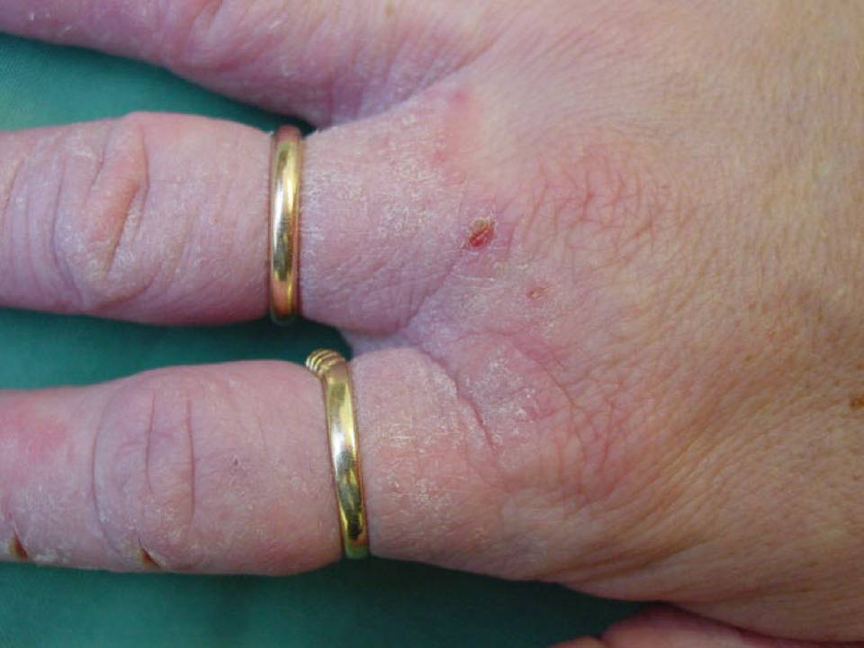 Consultations in Dermatology: A Sensitising Touch - Contact Dermatitis
