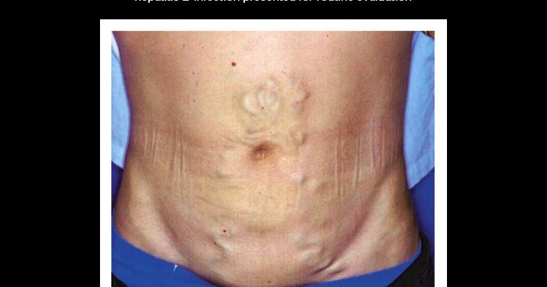 schiwago's BLOG: Caput medusae