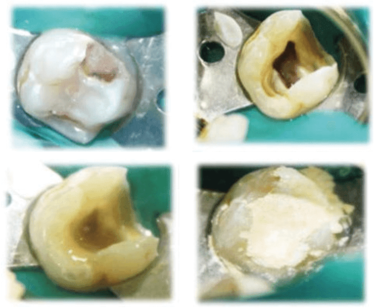 Endodoncia en Odontopediatria