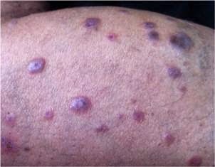 Teledermatology for PG entrance: How to decide level of Melanin in ...