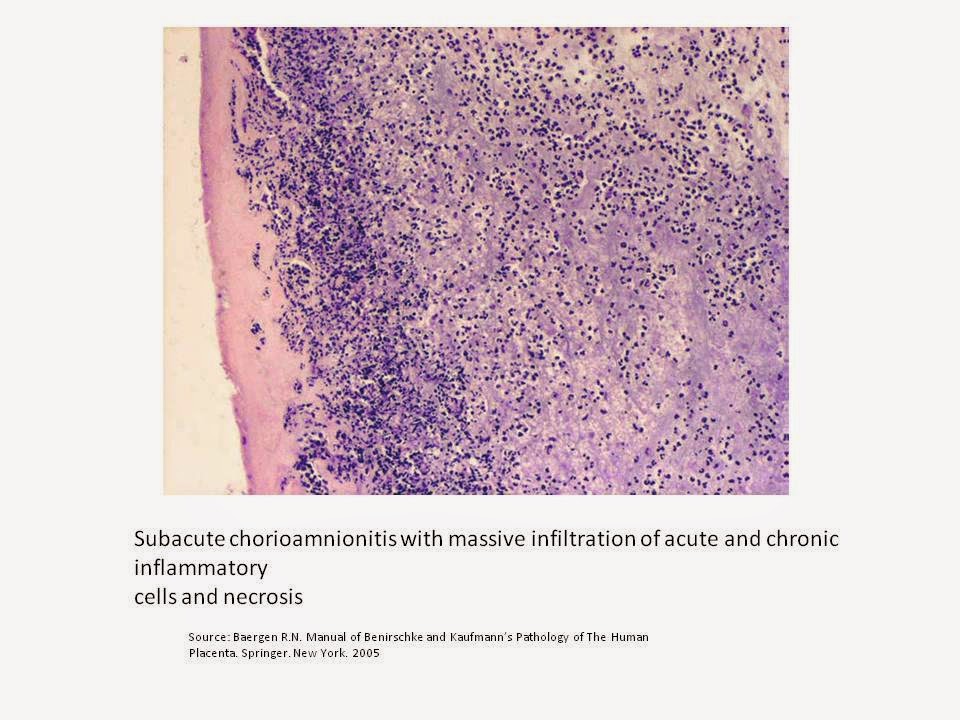 Reza Aditya Digambiro: Chorioamnionitis