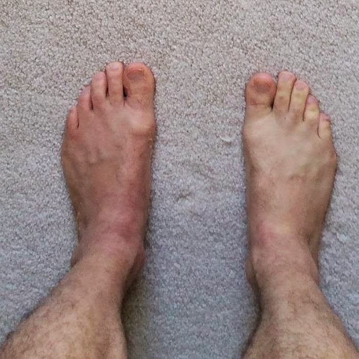 Mind - Body Thoughts: The Foot Rash Of Stress and Emotions