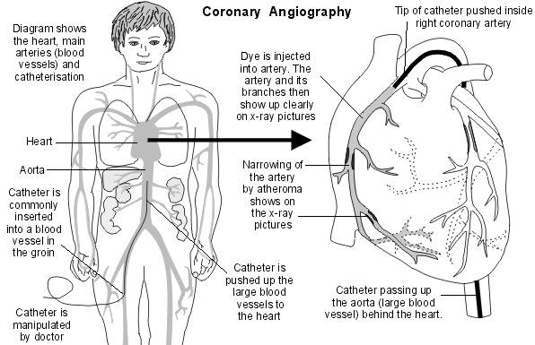 Radial Angioplasty - New approach in Cardiology