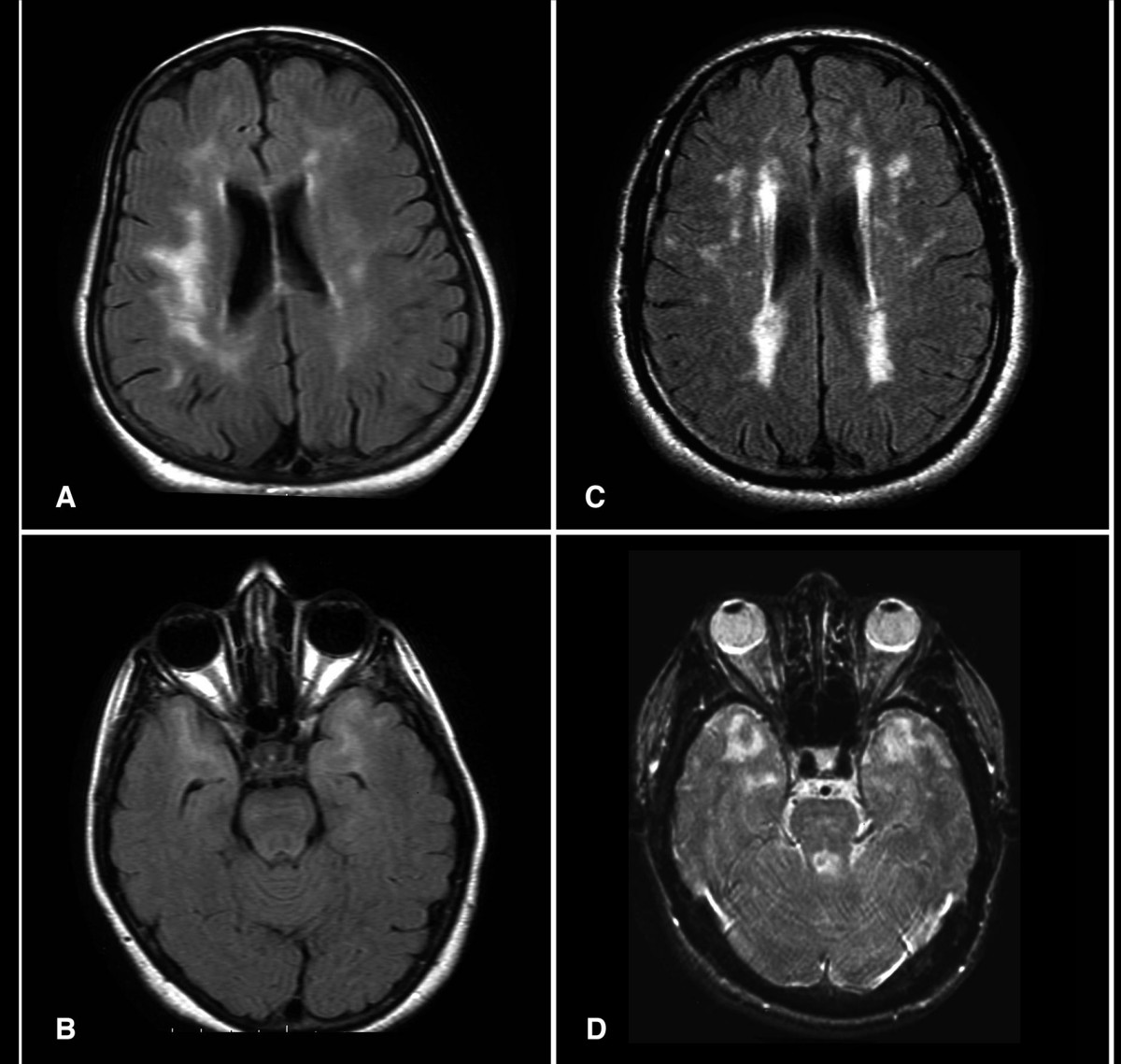 Stroke Notes: CADASIL typical temporal lobe imaging involving temporal pole