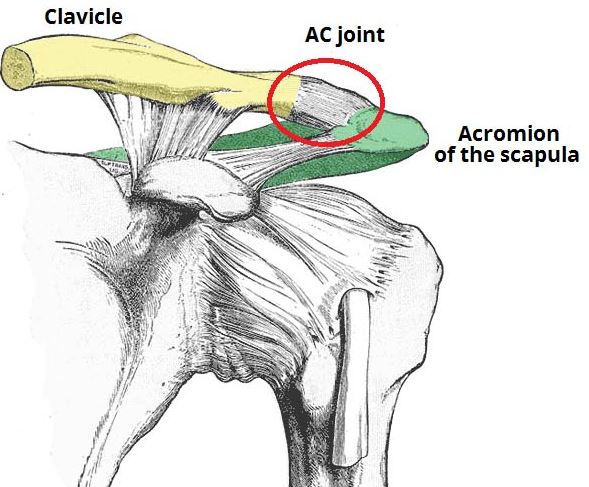 What is AC joint separation? Do I need surgery for this?