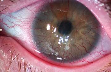 Limbal Follicles