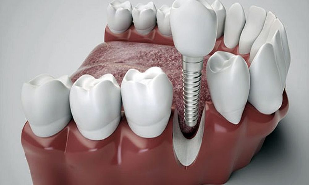 Implante dentário: 5 dicas para pacientes | Directorio Odontológico