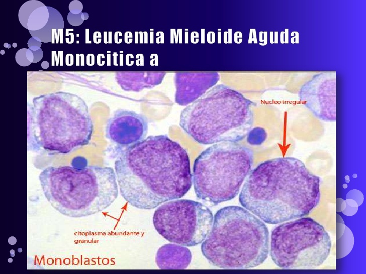 Células Sanguíneas: Leucemias Mieloides Agudas