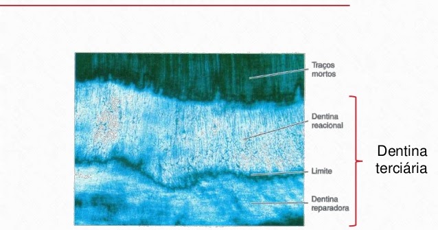 Cariologia web: TIPOS DE DENTINA Cariologia web: TIPOS DE DENTINA