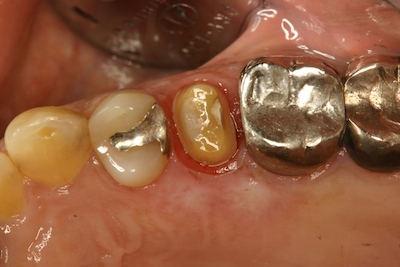 Drなるとのブログ: フルジルコニアクラウンの制作過程 FCZ Crown: Full Contour Zirconia Crown ,KATANA