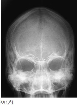 Medical Imaging Technology: Skull Radiography- Lateral and PA views
