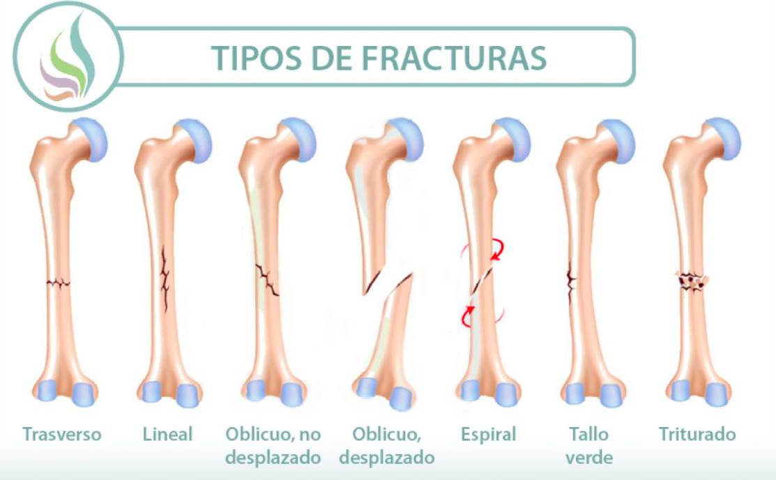 Aprende de una manera muy fácil los diferentes tipos de Fracturas Óseas ...