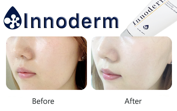Only Medical 온리메디칼: Only Medical Korea Skin care product : Innoderm ...
