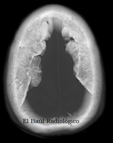 Hiperostosis frontal interna; Leontiasis Ósea; Síndrome de Morgagni ...