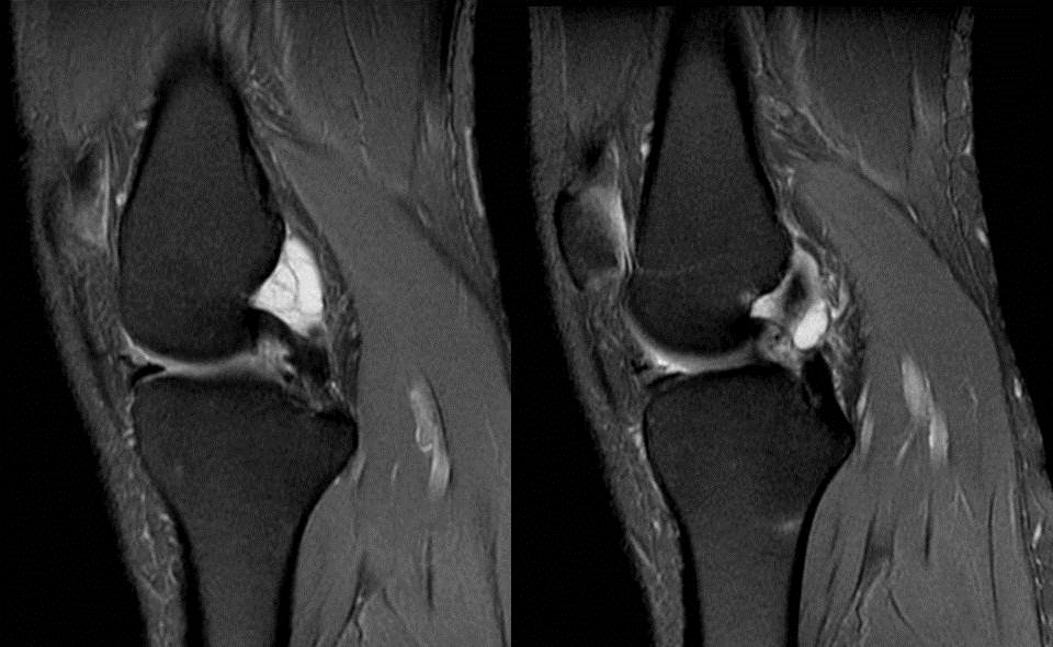 Radshare: GANGLION CYST OF KNEE