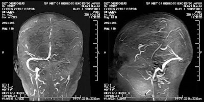 Thrombose du sinus sagittal; Phlébite septique du sinus sagittal ...