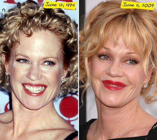 Melanie Griffith Plastic Surgery Before and After Botox and Facelift ...