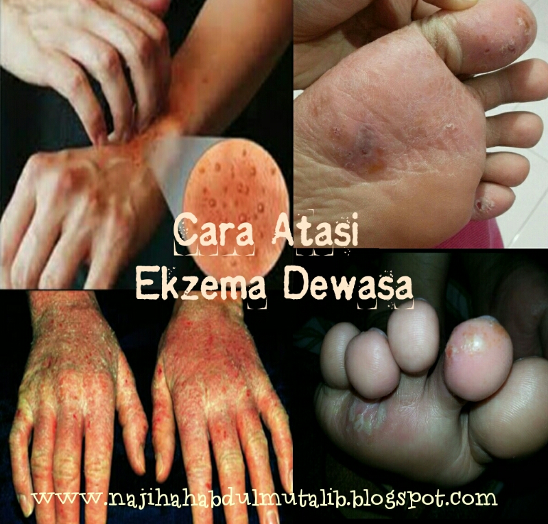 Rahsia Suri: Keluarga & Kerjaya: Cara Pulihkan Ekzema dan Elergi Orang ...