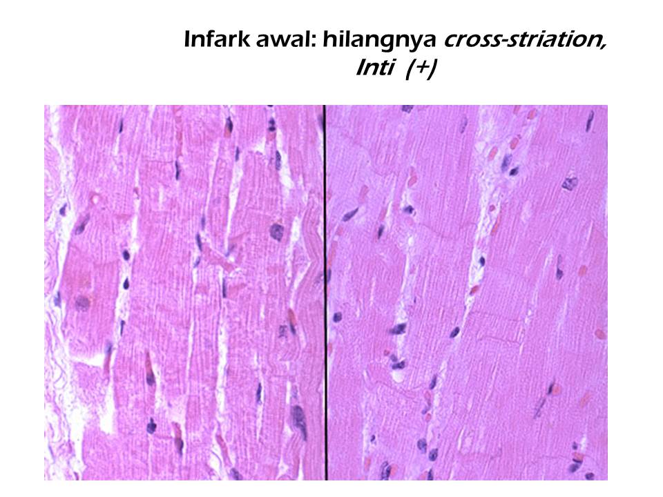 Reza Aditya Digambiro: MIOKARD INFARK