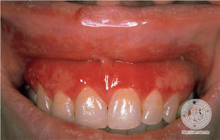 The Daily Floss: Just Flappin' My Gums: Preventitive Procedures: How ...