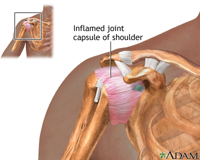 Andrew Heilbrunn Biokineticists: Adhesive Capsulitis ("Frozen Shoulder ...