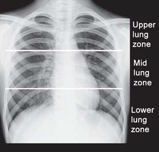 Study Medical Photos: Simplified Approach To Reading Chest X- Rays.