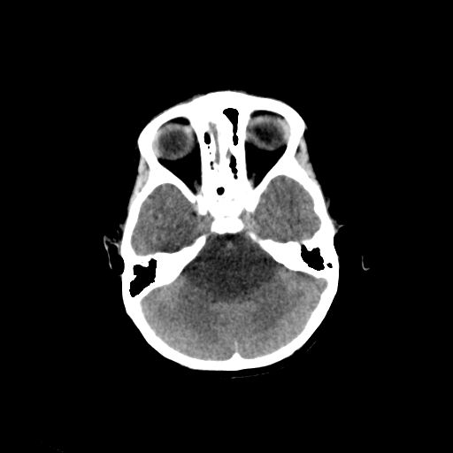IRRADIATED - Radiology: DIFFUSE PONTINE GLIOMA