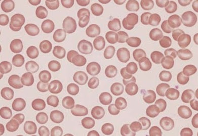 HEMATOLOGÍA: Serie Roja