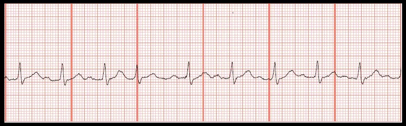 Practice EKG Rhythm Strips 122