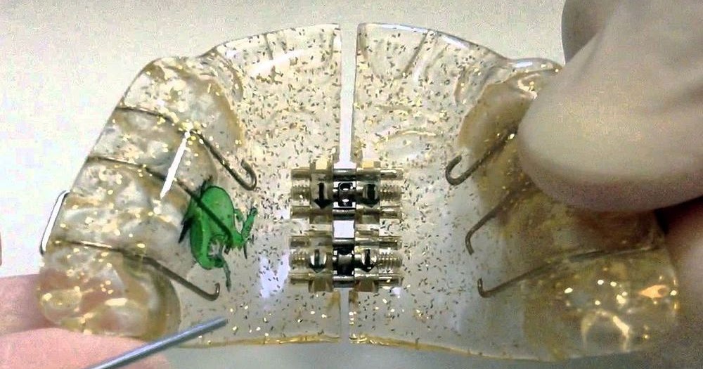 ORTOPEDIA : Como activar el tornillo de una placa de expansión - odontobebe