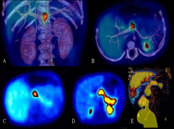 Cancer Biology: Diagnosing Pancreatic Cancer using a PET Scan