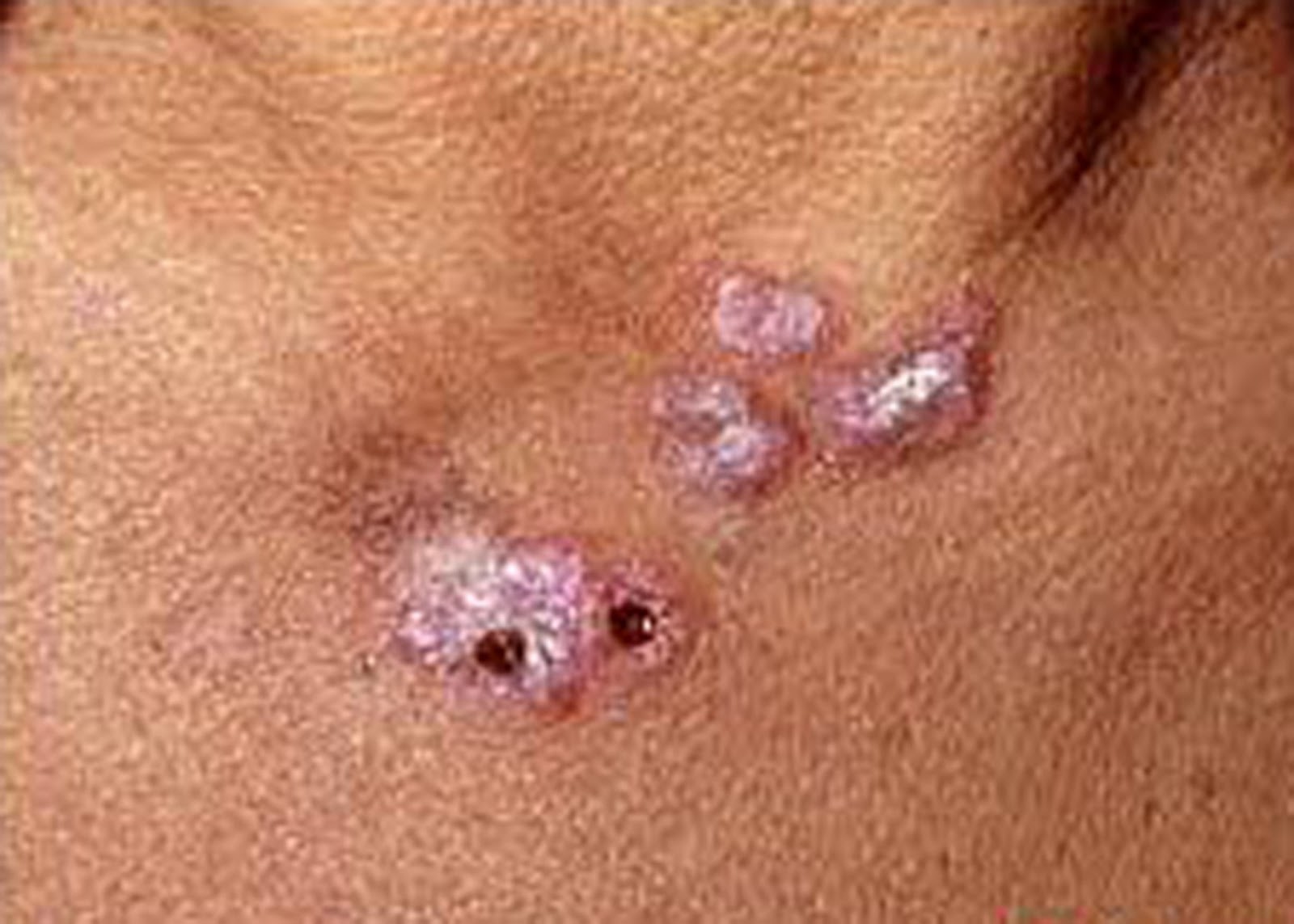 LUPUS SYMPTOMS AND DIAGNOSIS ~ HEALTHCARE