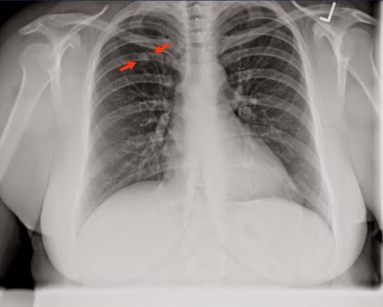 ESPE 203-2013: Caso clínico: Nódulo Pulmonar Solitario
