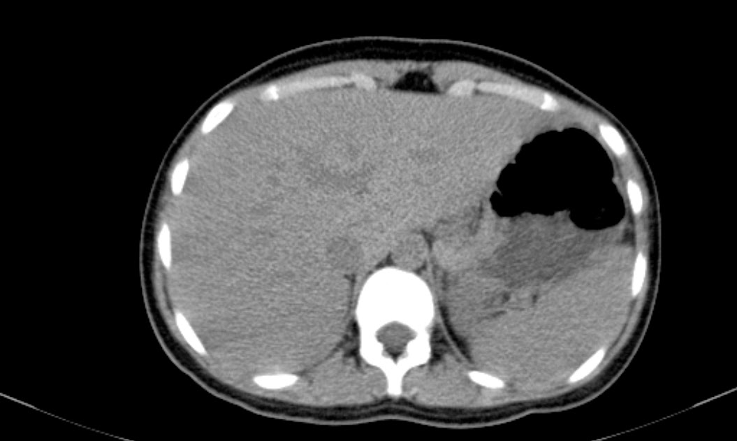 Ultimate Radiology : Pseudolesion : Papillary Process of Caudate Lobe