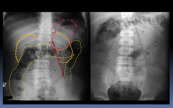 Anatomía Radiológica de Pelvis y Abdomen