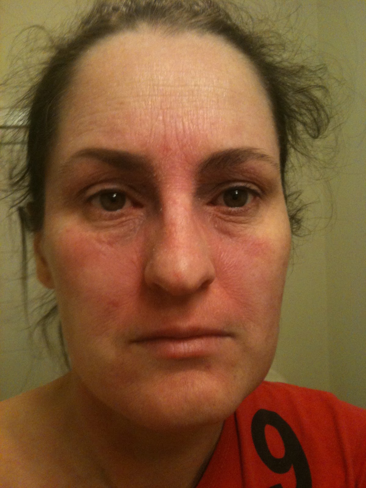 Topical Steroid Withdrawal Journey-Healing Eczema and Red Skin Syndrome ...