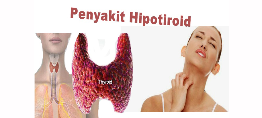 Penyakit Tiroid Dan Cara Rawatan