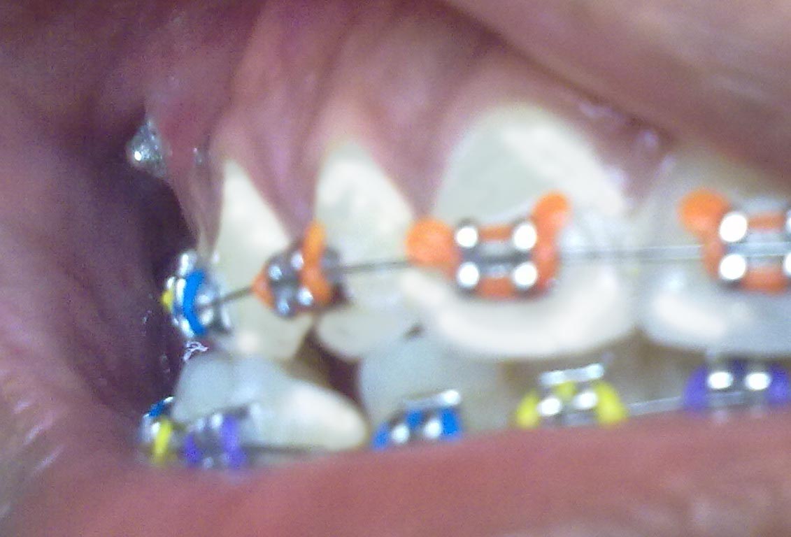 Mr Braces 7Eleven: Appt Tukar Getah Braces - Blue, Purple & Yellow ...