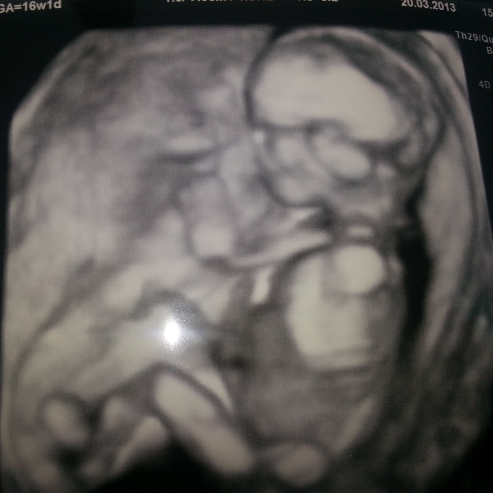 Just a normal girl: 16 week gender scan