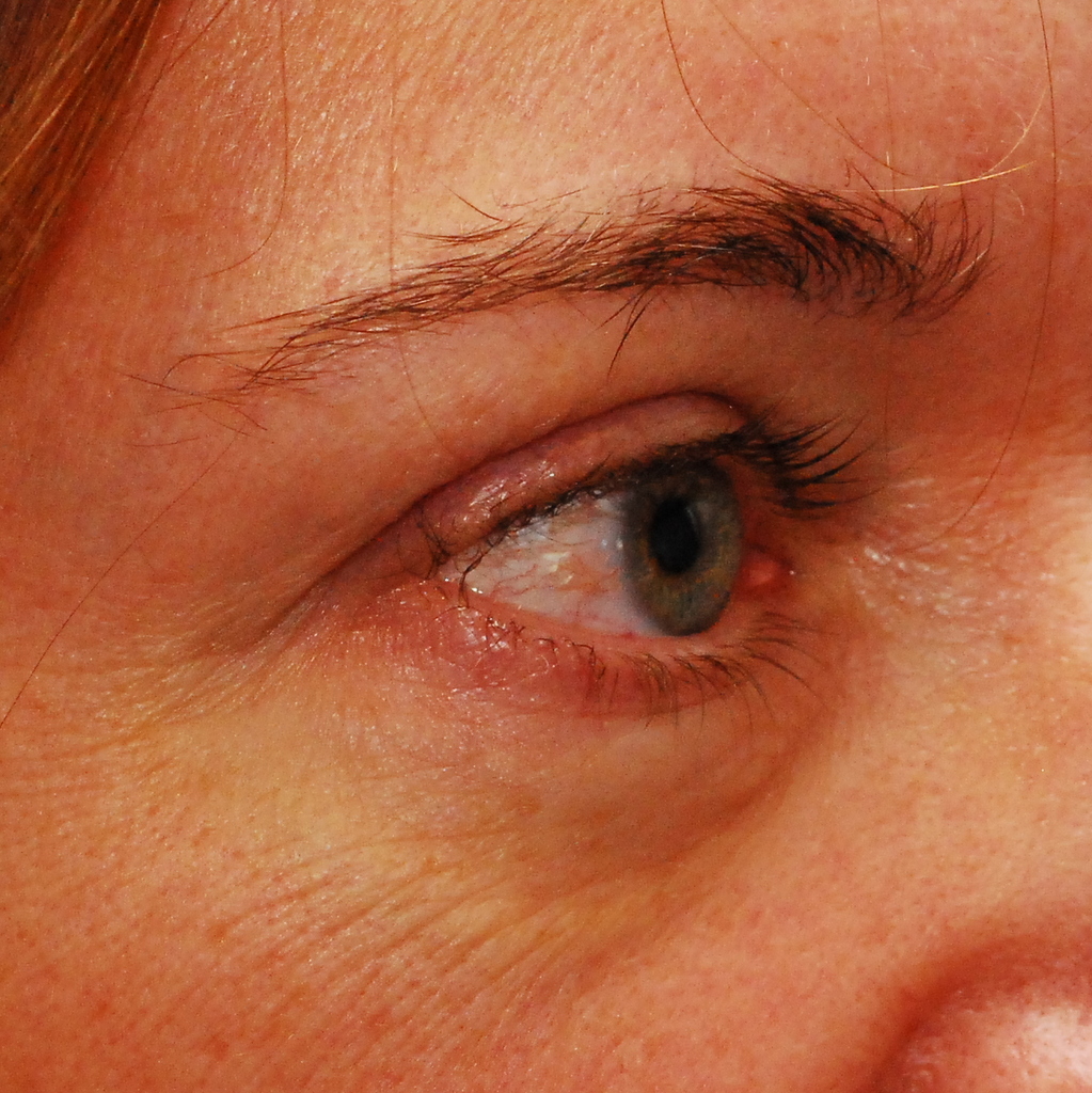 Stephen Weber, MD, FACS: Transconjunctival vs. Transcutaneous ...