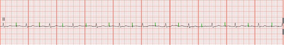 EKG Rhythm Strip Quiz 56: Paced Rhythms